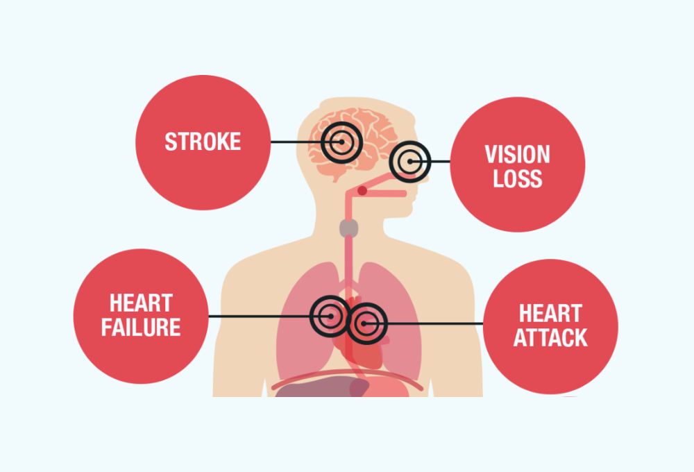 Why is Hypertension called the Silent Killer – WellaHealth