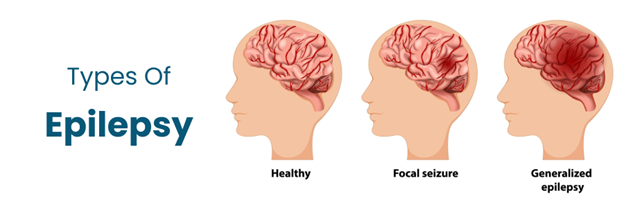 Epilepsy: Can You Live A Normal Life? – WellaHealth
